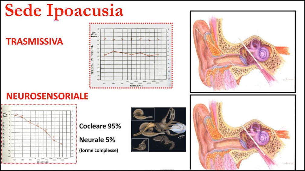 Ipoacusia: gli Esami di Secondo Livello - Maurizio G. Vigili