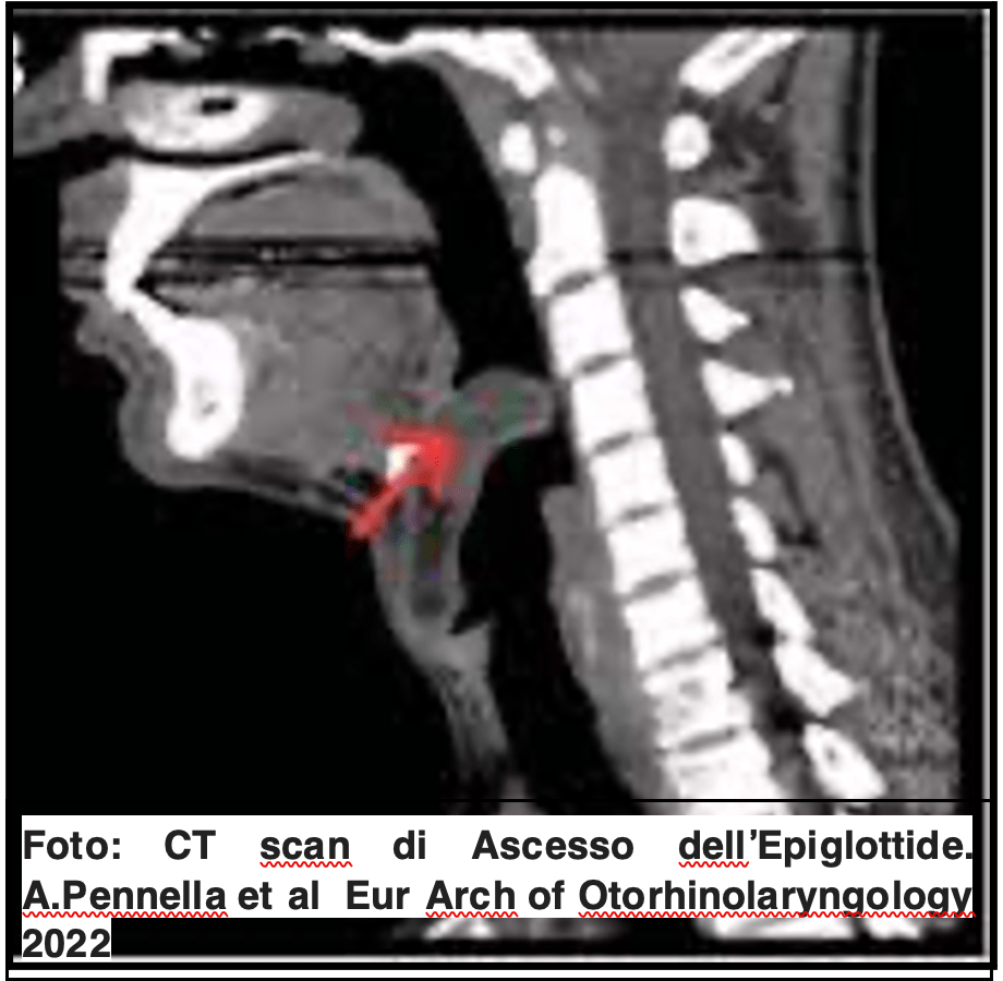 Fattori di rischio per la formazione di ascesso dell’epiglottide ...