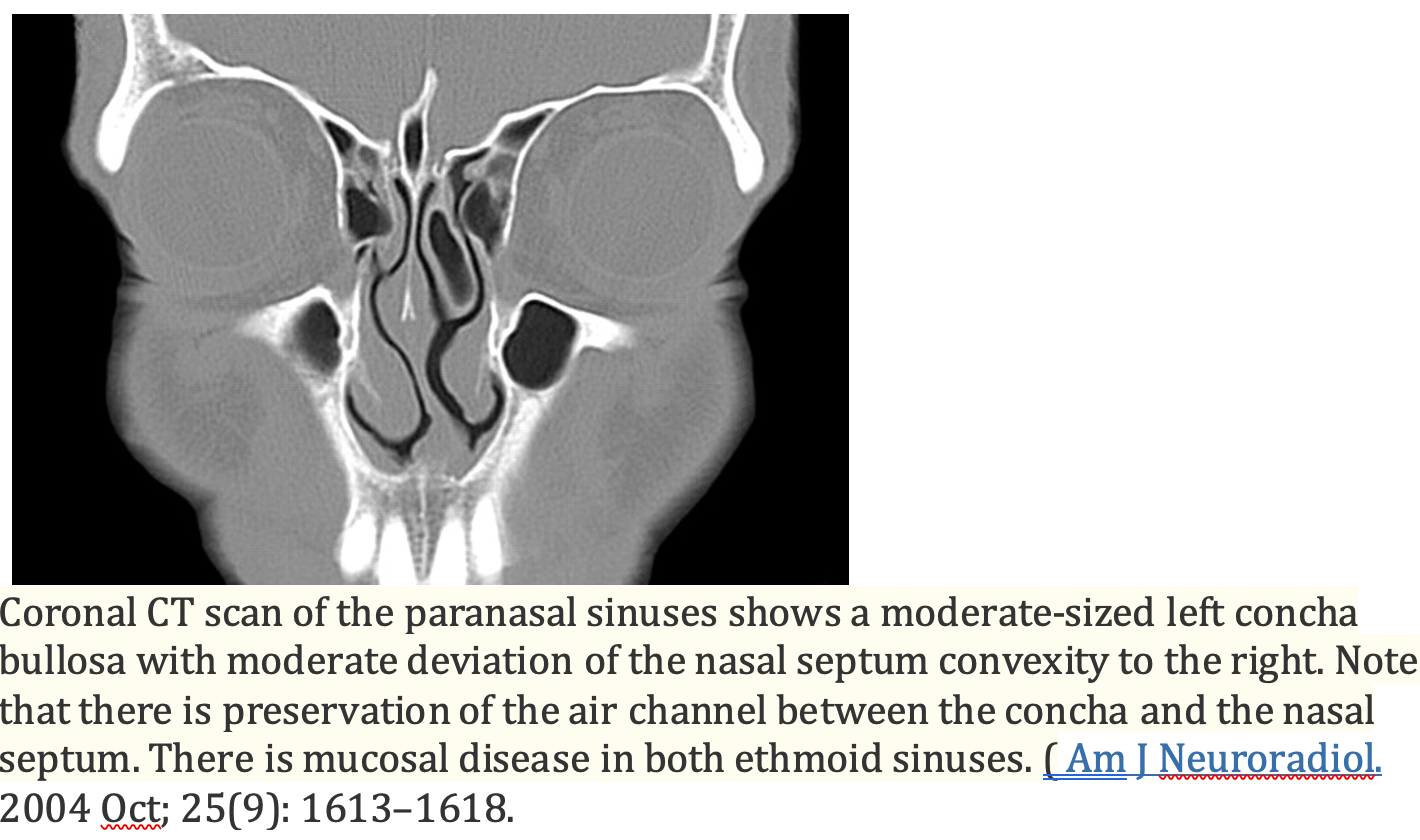 La Concha Bullosa ed il suo valore anatomo clinico nella patologia ...