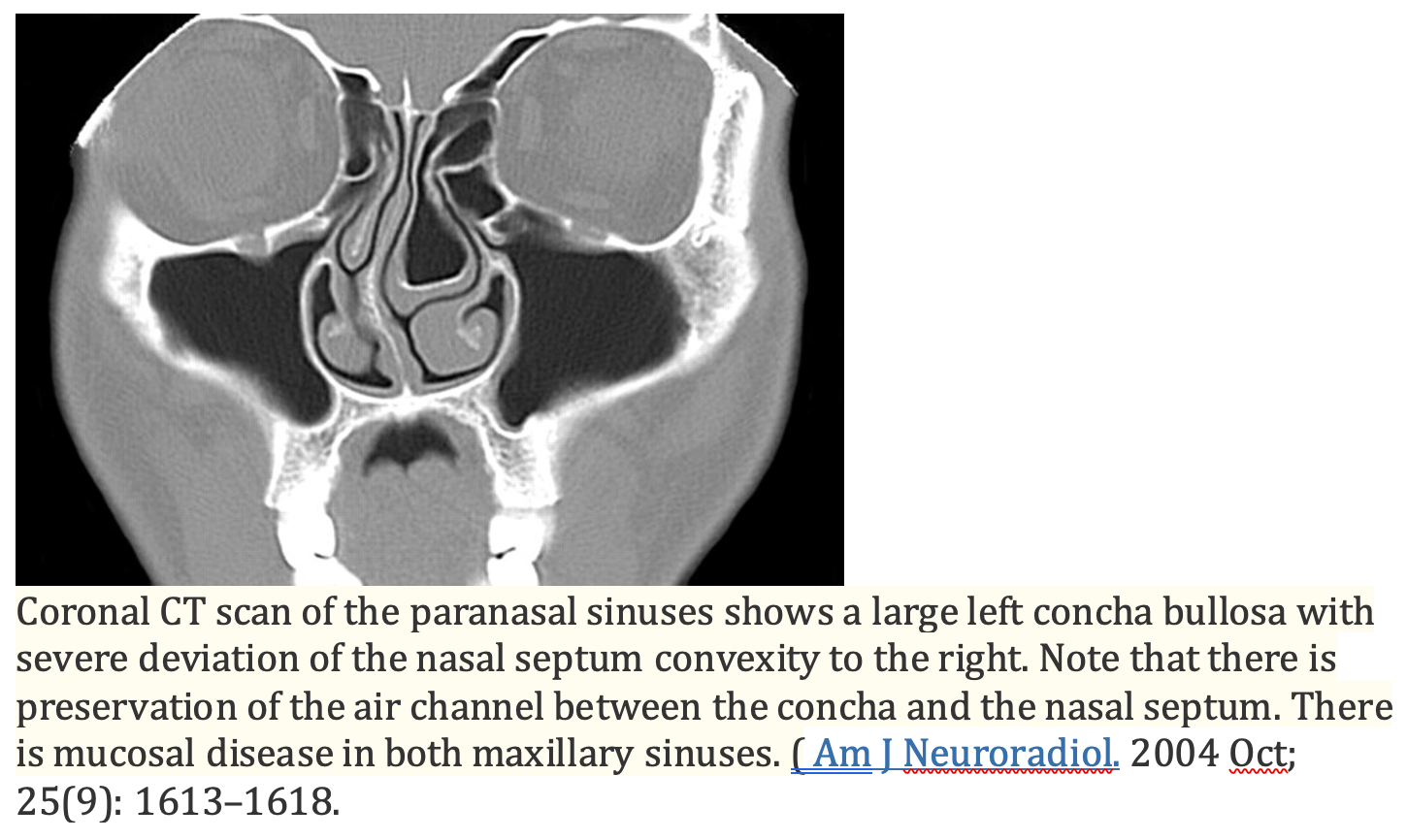La Concha Bullosa ed il suo valore anatomo clinico nella patologia ...