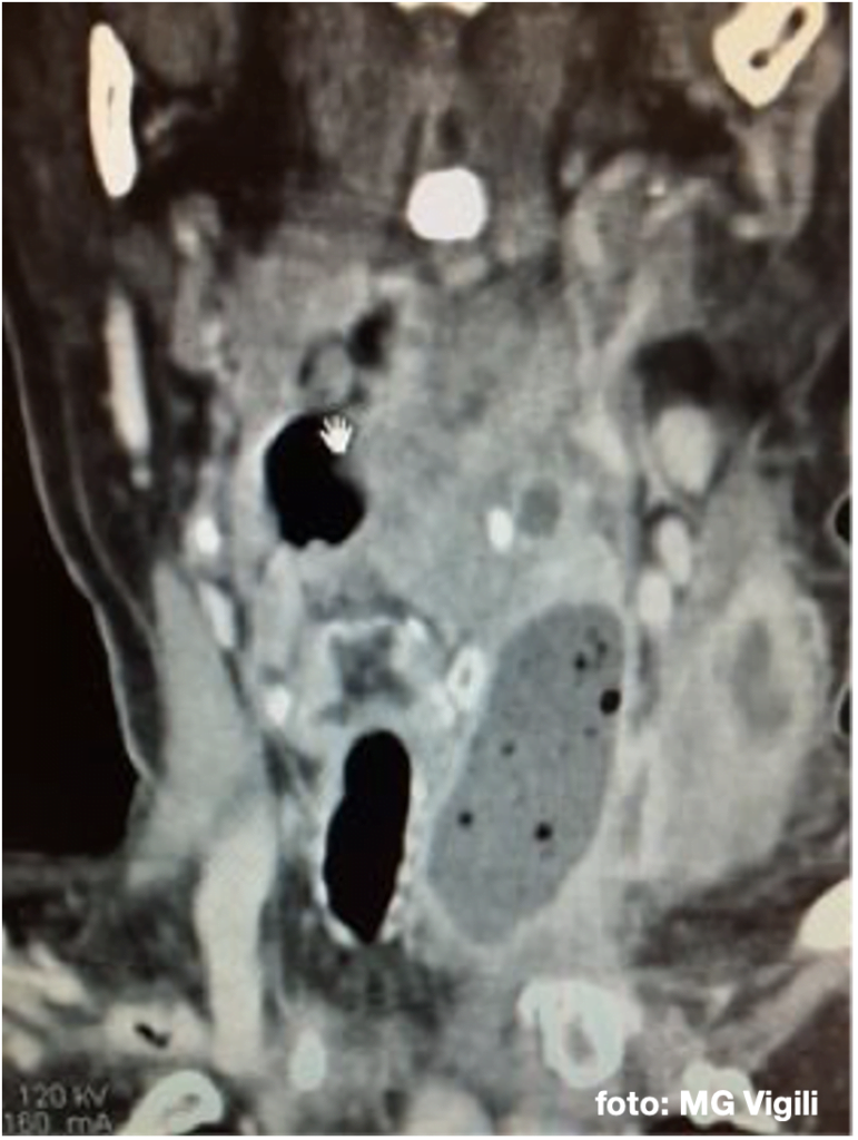 Ascesso parafaringeo e retrofaringeo: evoluzione clinica e differenze ...